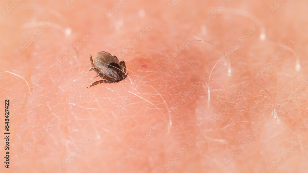 Parasitic deer tick bitten in human skin at sucking blood. Ixodes ...