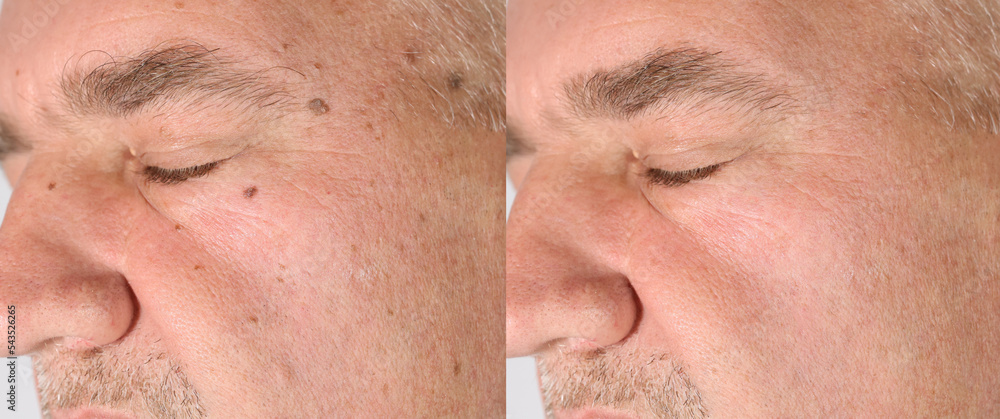 Comparison before and after skin laser treatment black spot on human ...