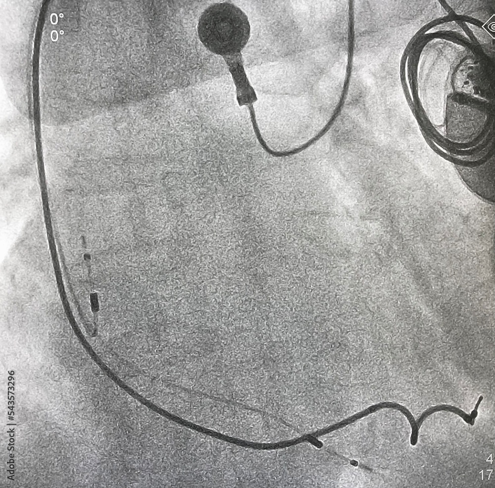 X-ray image during Cardiac resynchronization therapy pacemakers (CRT-P ...