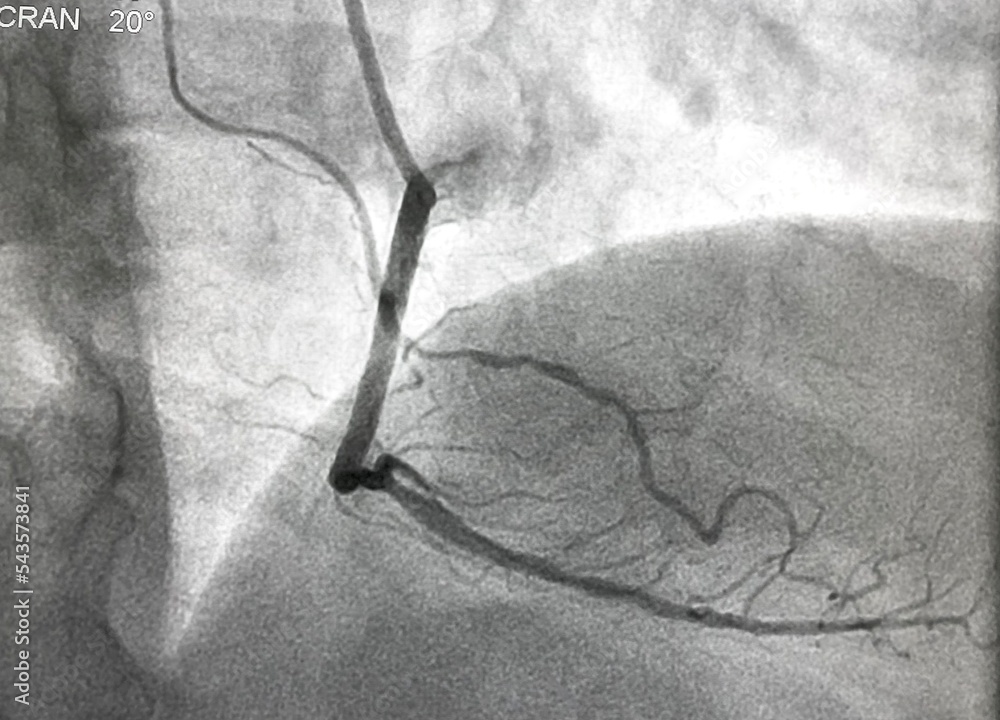 Coronary angiogram (CAG) of right coronary artery (RCA). Stock Photo ...