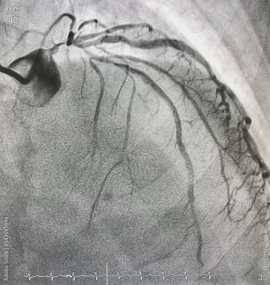 Coronary angiography shown left main (LM) stenosis with triple vessel ...