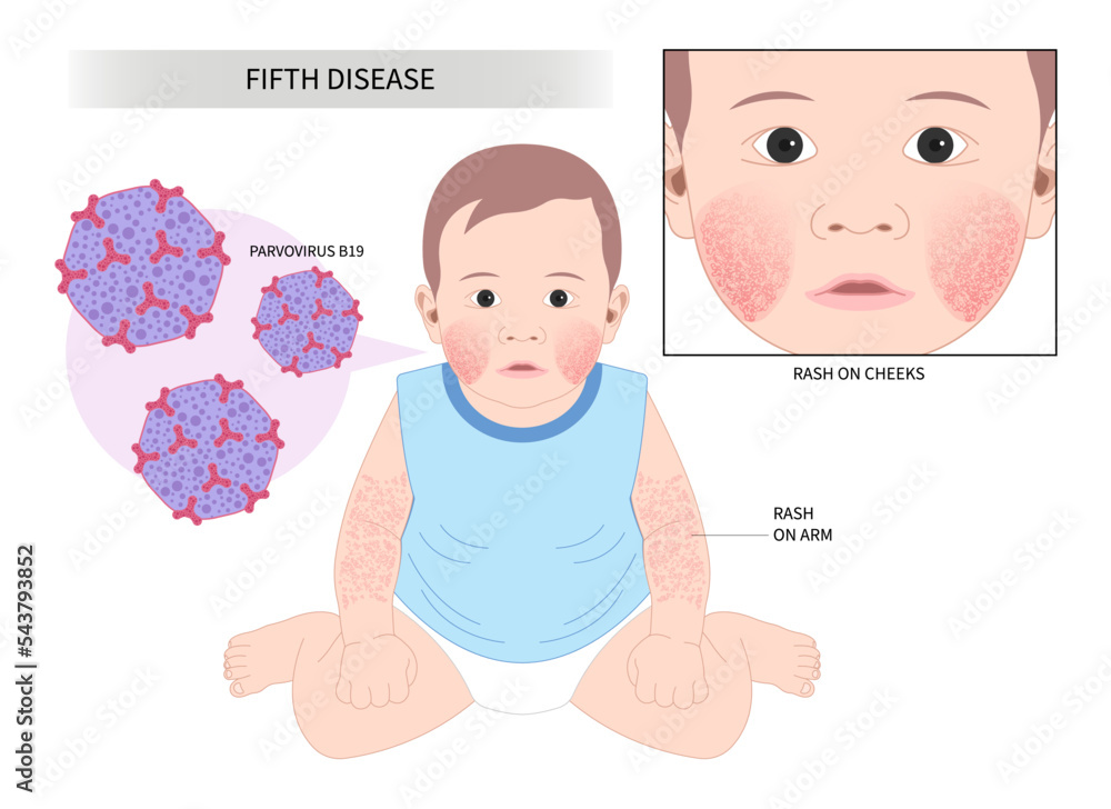 Fifth disease facial reaction slapped cheek child toddler human herpes ...