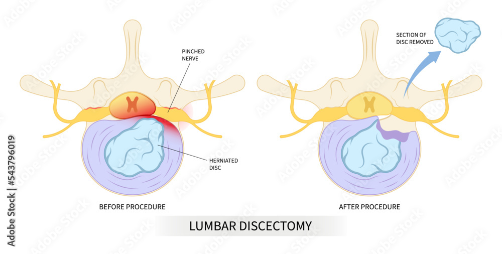 lumbar laminectomy spine cord surgery of root back pain disc tumor ...