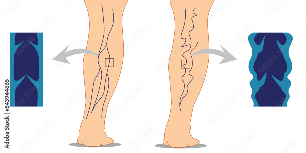 Varicose veins illustration. Normal and illness leg with varicose veins ...