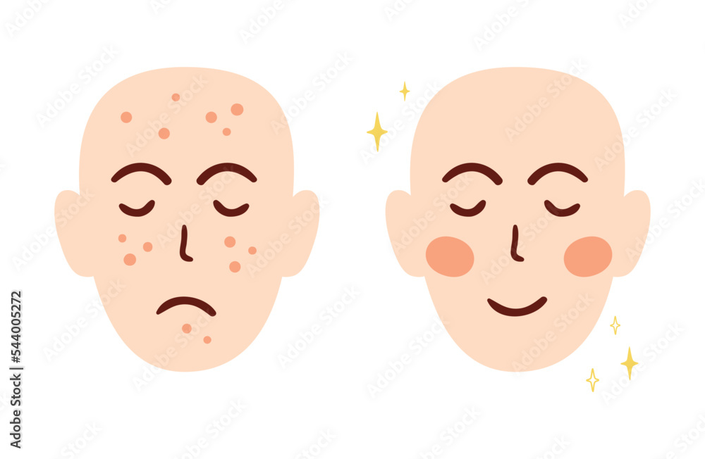 Acne face treatment concept with two different faces before and after ...