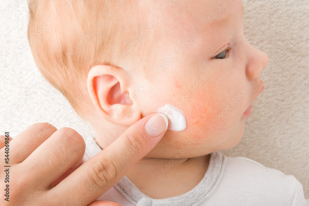 Young adult mother finger applying white medical ointment on newborn ...