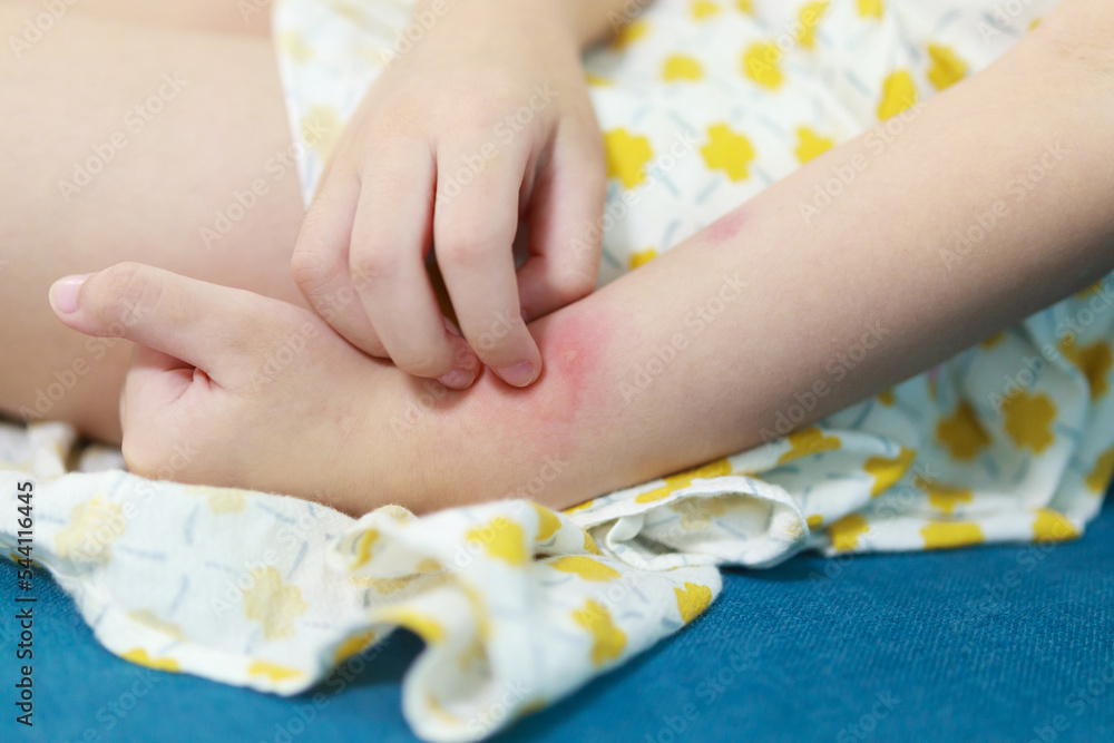 Little girl has skin rash allergy itching and scratching on her arm ...
