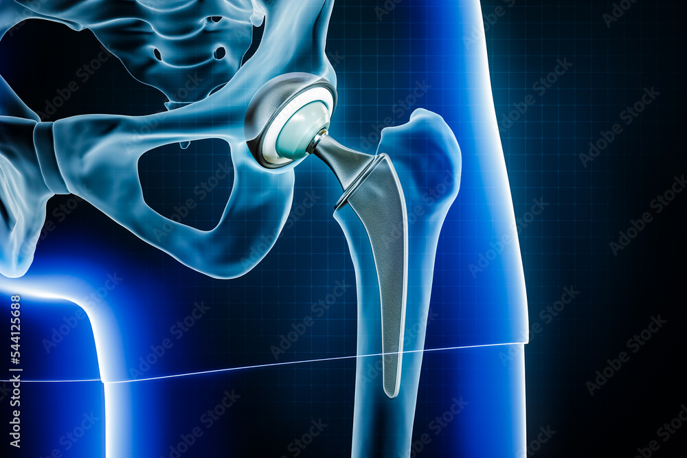 Femoral Head Hip Prosthesis Or Implant Total Hip Joint Replacement Surgery Or Arthroplasty 3d