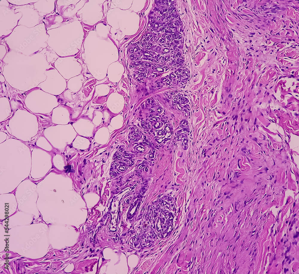 Prepatellar region histology: Chronic bursitis. light microscopic image ...