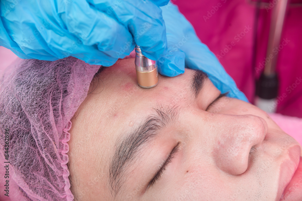 An Esthetician performs a Diamond peel facial, a type of ...