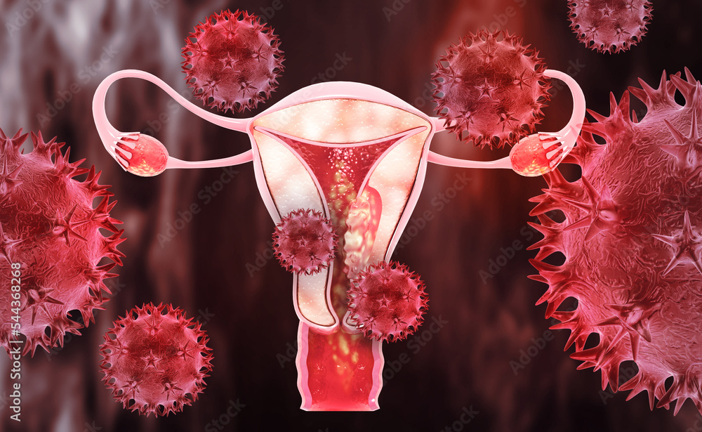 Uterus or uterine cancer. Medical concept as cancerous cells spreading ...