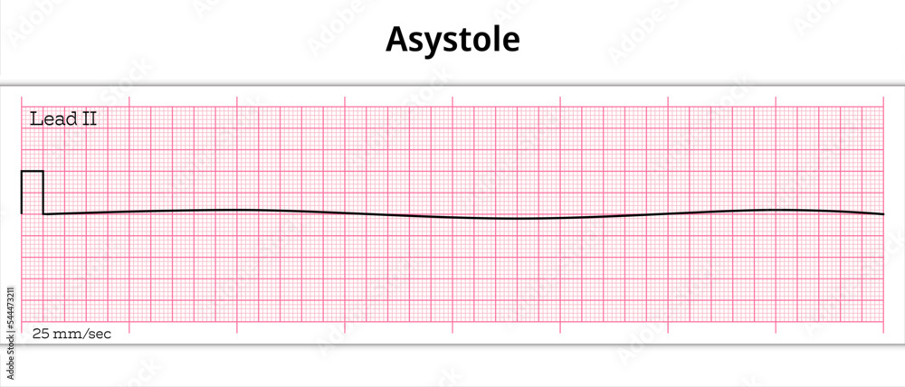 Vetor de ECG Asystole - 8 Second ECG Paper do Stock | Adobe Stock