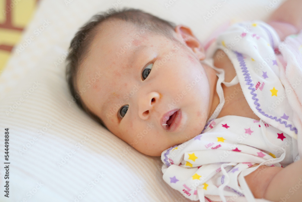 Prickly heat rash on baby face, miliaria Stock Photo | Adobe Stock