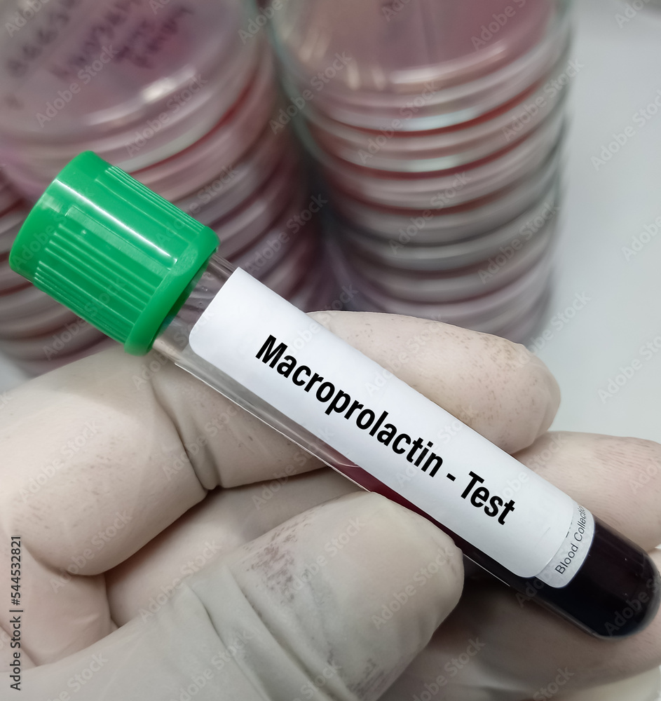 Blood sample for macroprolactin test, macroprolactin screening test ...