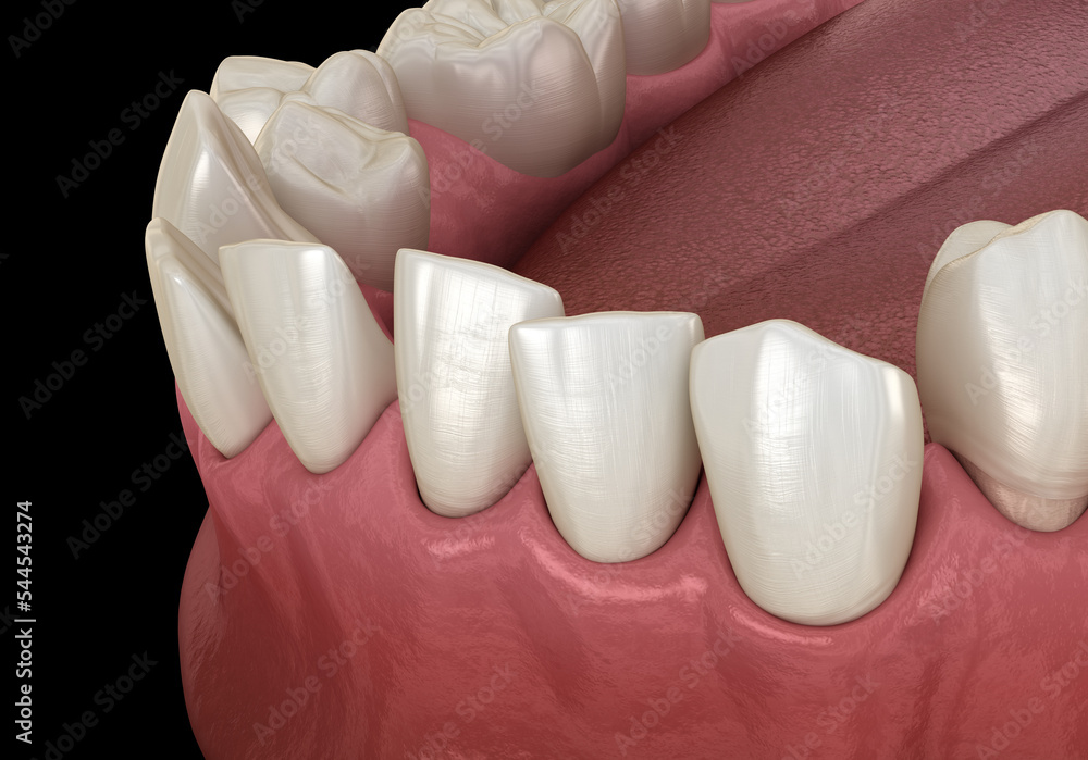 Overcrowded teeth, abnormal dental occlusion. Medically accurate tooth ...