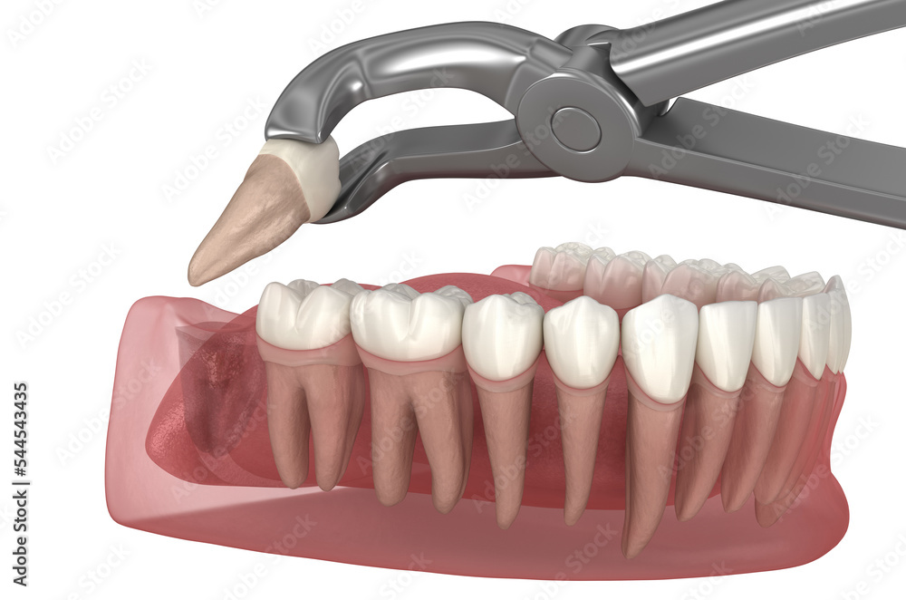 Extraction of wisdom tooth. Medically accurate tooth 3D illustration ...