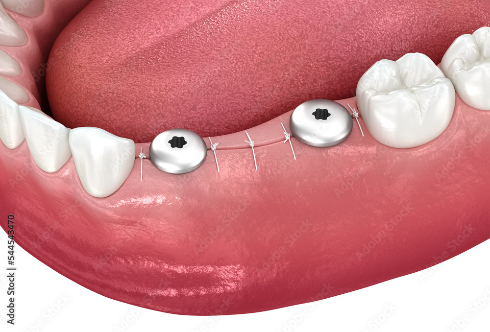 Poster Gingiva former over implant. Medically accurate 3D illustration ...