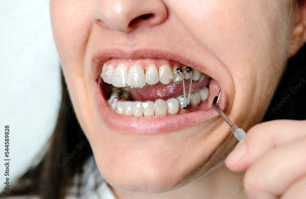 Closeup of unrecognizable woman open mouth using dental buttons and ...