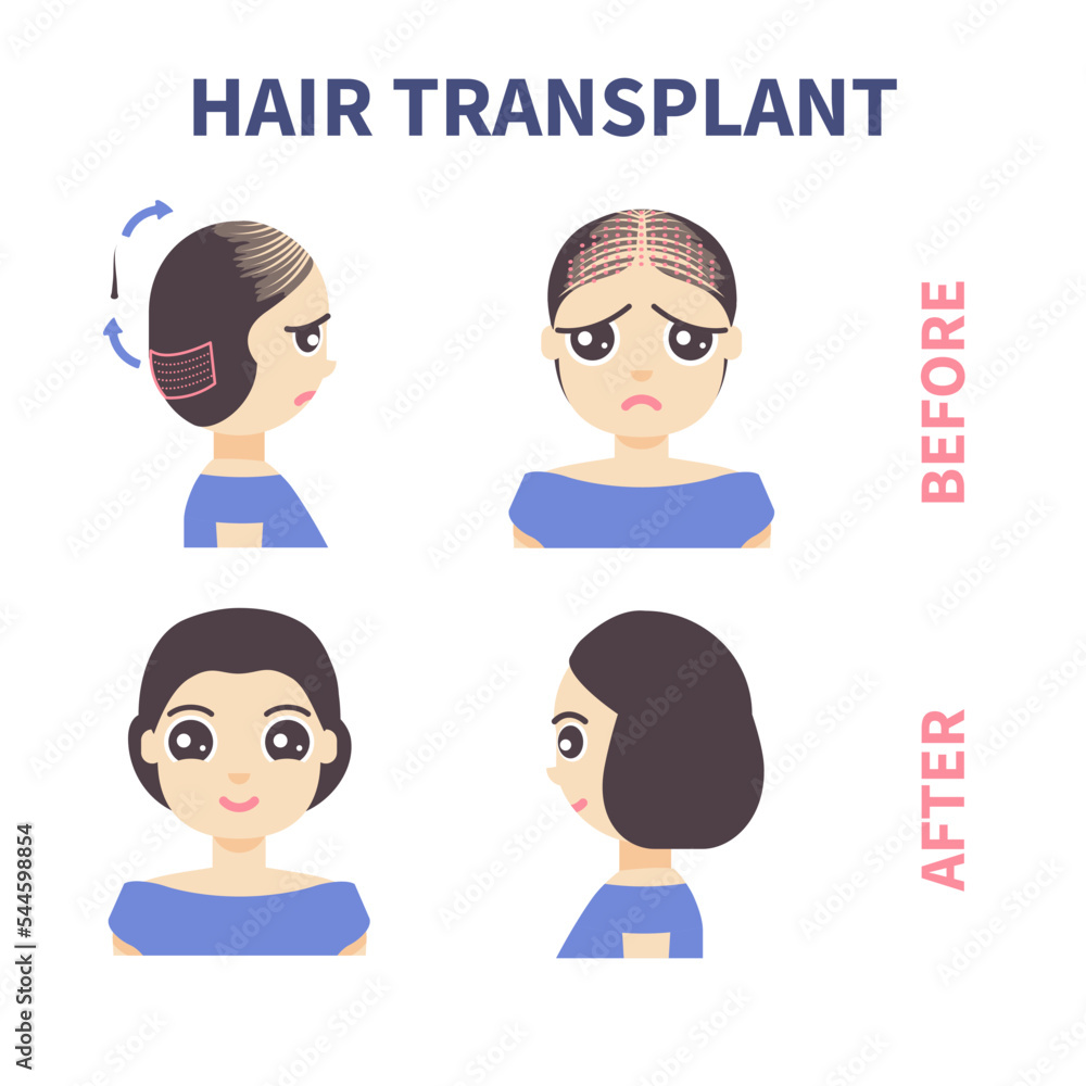 FUE hair transplant treatment of alopecia. Front and side view of a ...