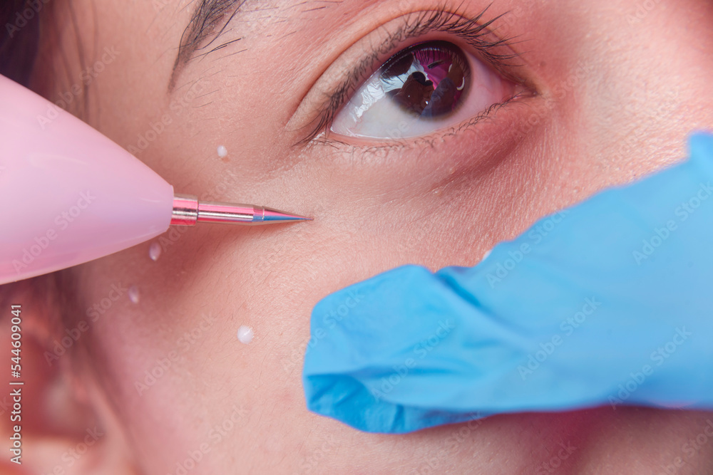 An esthetician uses a mini wireless cautery machine to remove warts ...