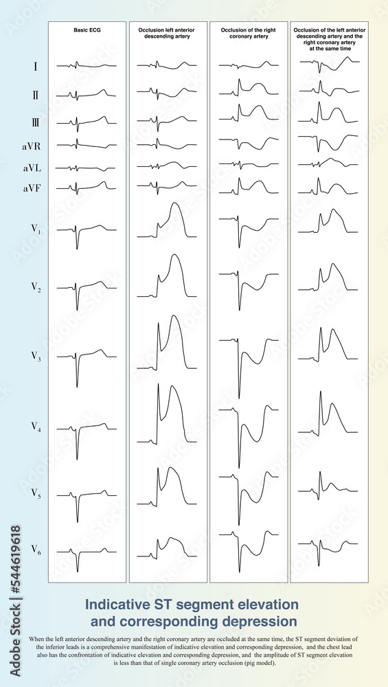 When the two coronary arteries are occluded at the same time, the ST ...