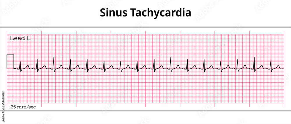ECG Sinus Tachycardia - 8 Second ECG Paper Stock Vector | Adobe Stock