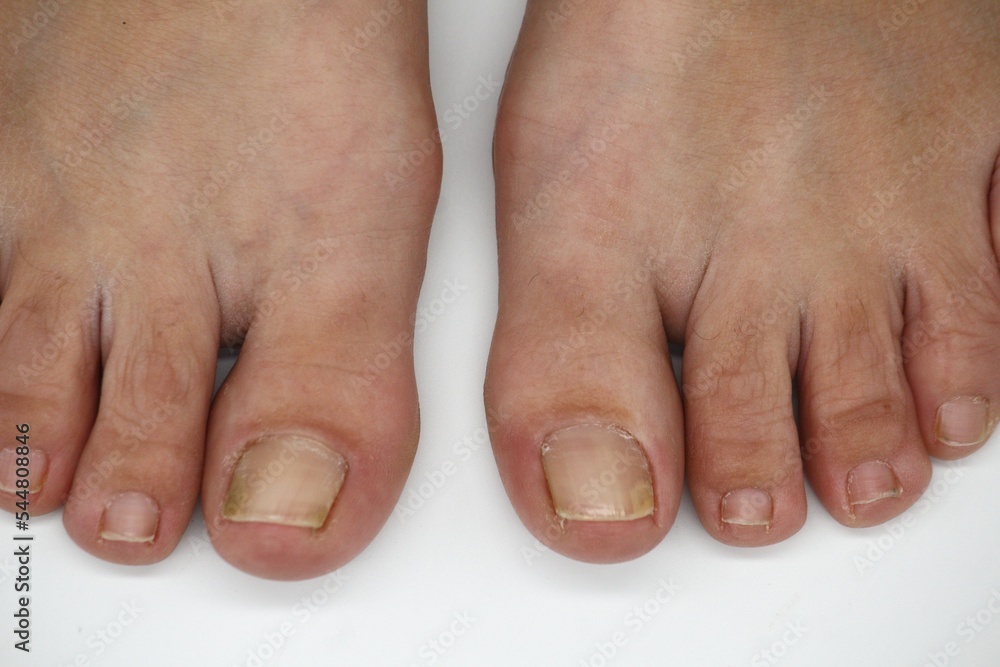 Big toe nail of a person suffering from onychomycosis a fungal ...
