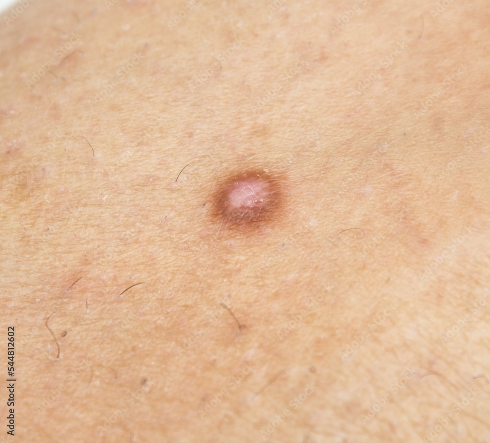 hemosiderotic dermatofibroma on woman´s leg, scar on the skin Stock ...