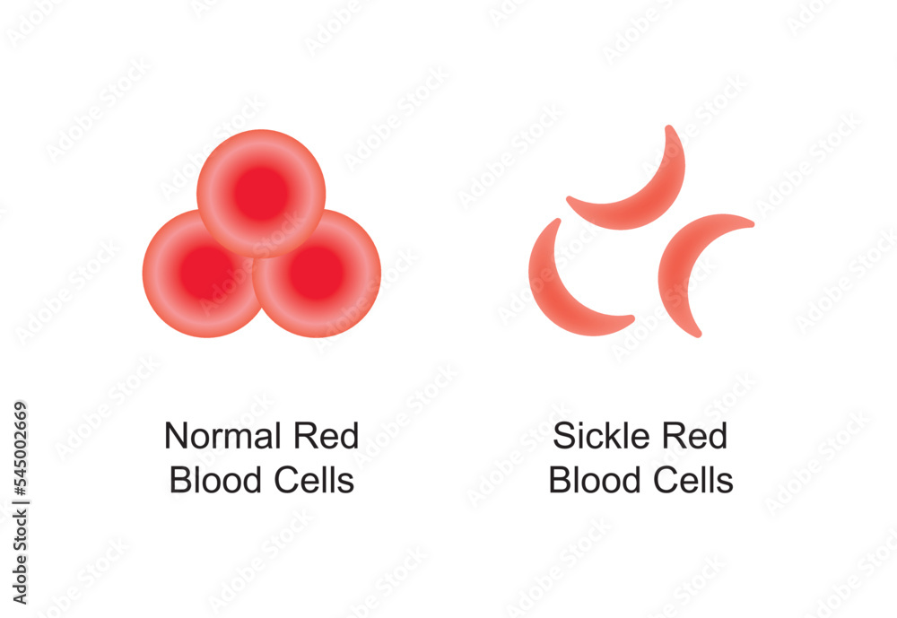 Scientific Designing of Normal and Sickle Red Blood Cell Comparison ...