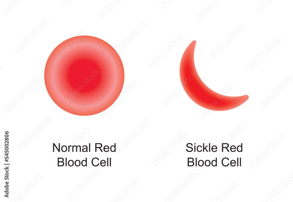 Scientific Designing of Normal and Sickle Red Blood Cell Comparison ...
