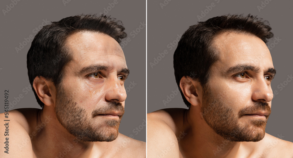 Collage of two portraits of mature man before and after rejuvenation ...
