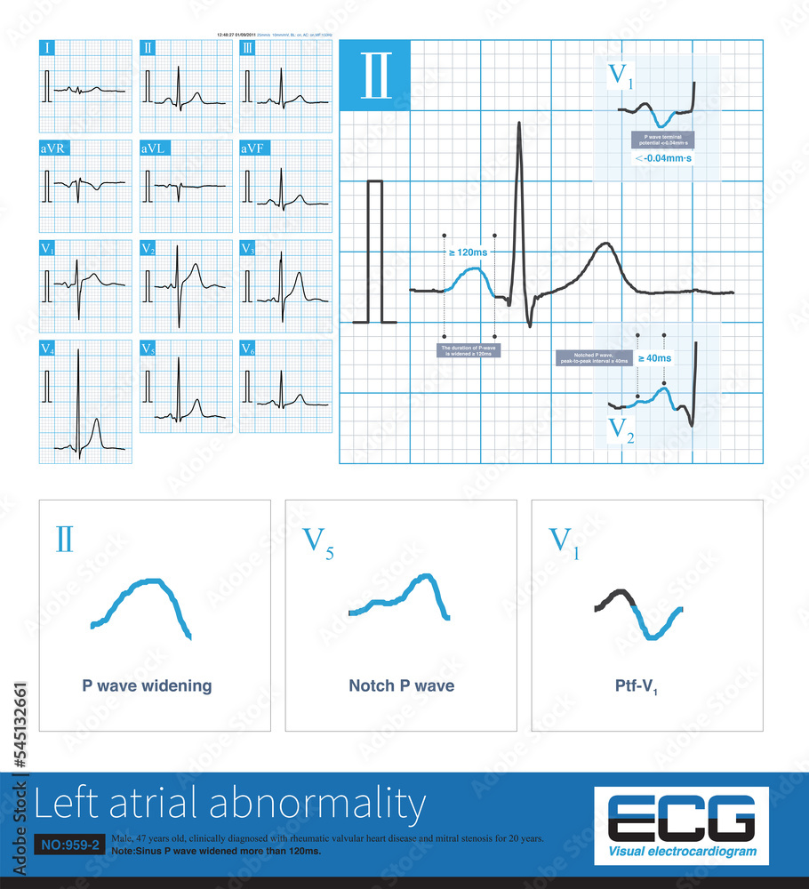 In clinic, mitral stenosis is a common organic heart disease that leads ...