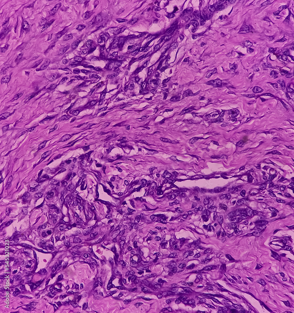 Prepatellar region histology: Chronic bursitis. light microscopic image ...