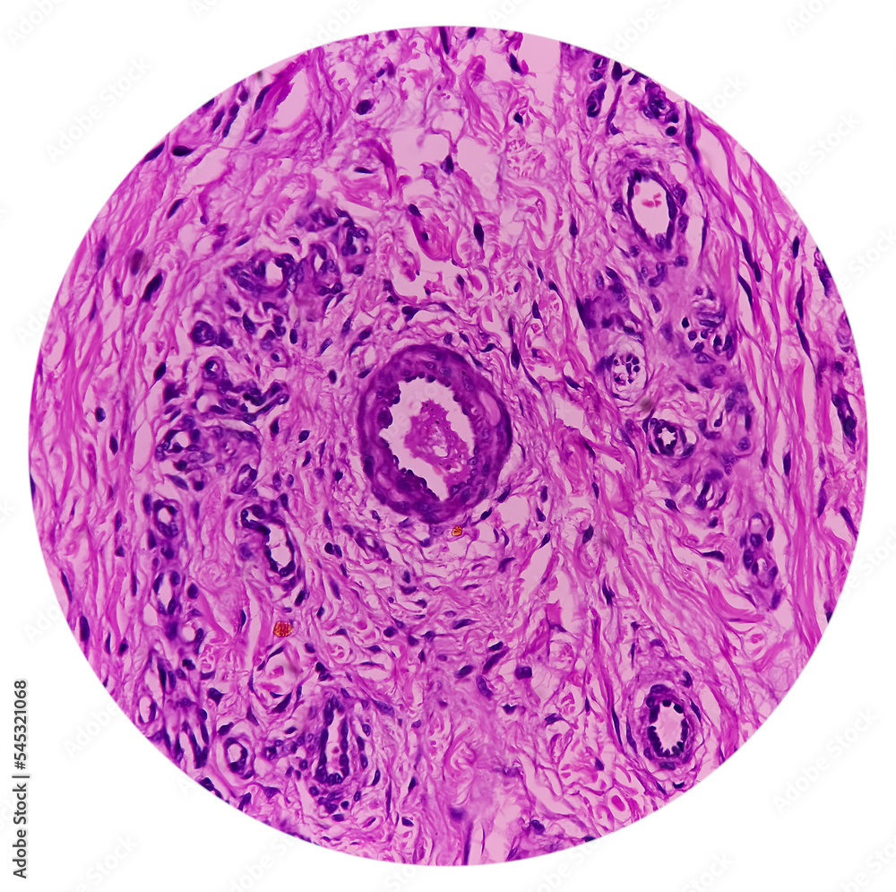 Stockfoto Prepatellar region histology: Chronic bursitis. light ...