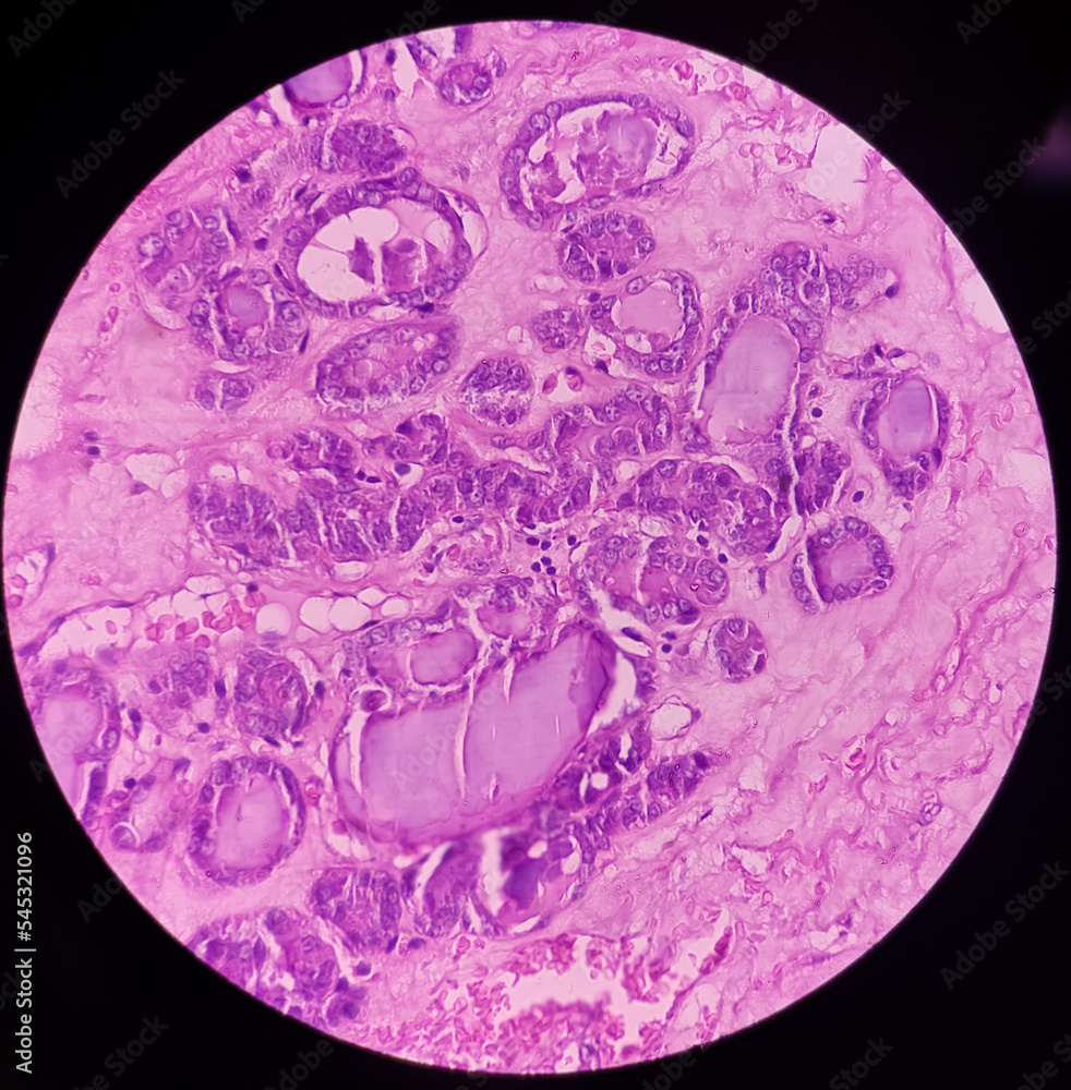 Follicular adenoma of thyroid gland, light micrograph. Histopathology ...