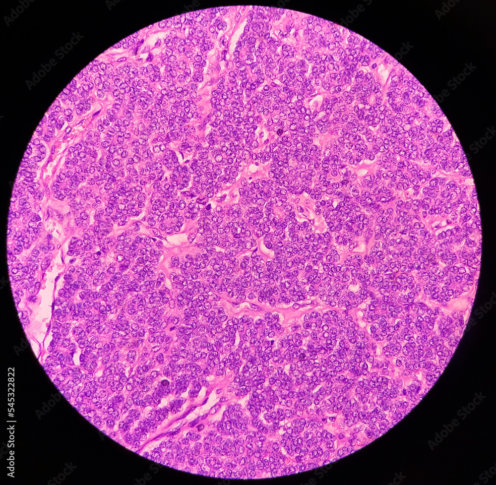 Thyroid cancer: Microscopic image of Follicular variant of papillary ...