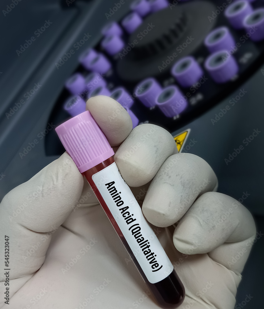 Blood sample for amino acid (Qualitative) test in PCR laboratory. Stock ...