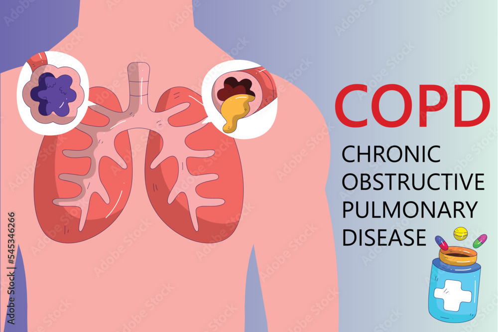 COPD (Chronic Obstructive Pulmonary Disease). Lung have breathing ...