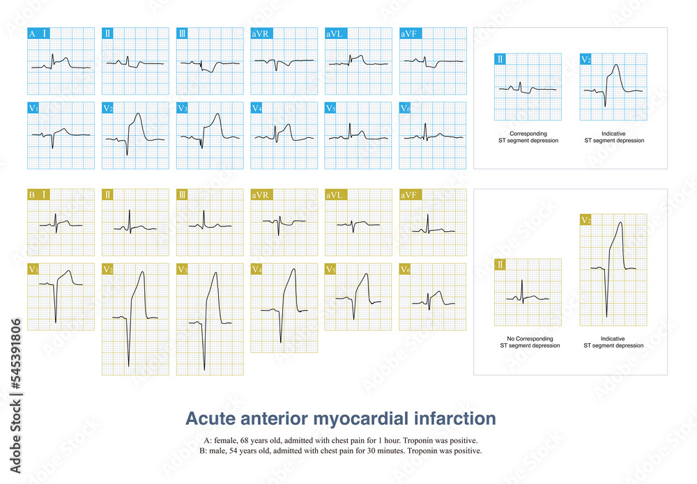 In some patients with acute anterior myocardial infarction, the ...