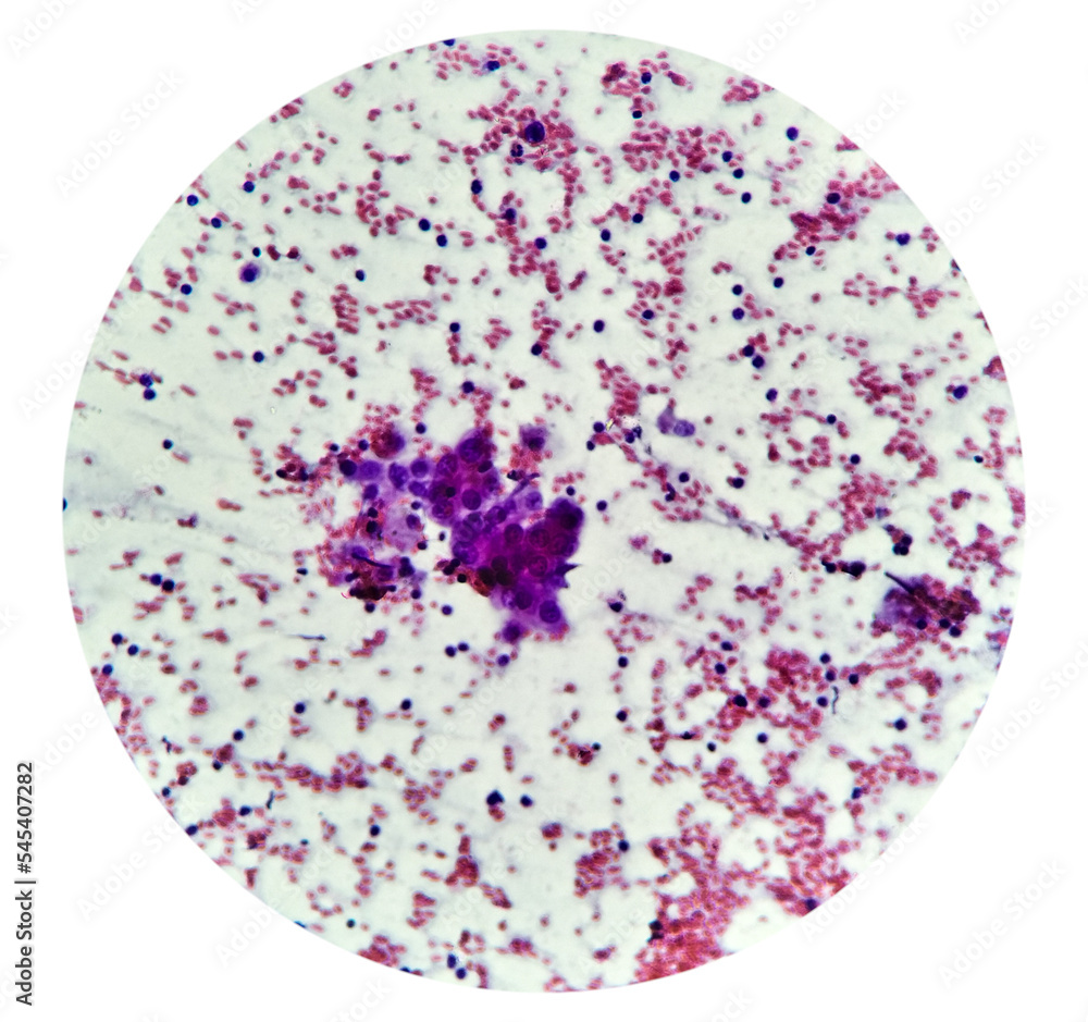 Intra abdominal mass(Cytology): Spindle cell sarcoma, positive ...