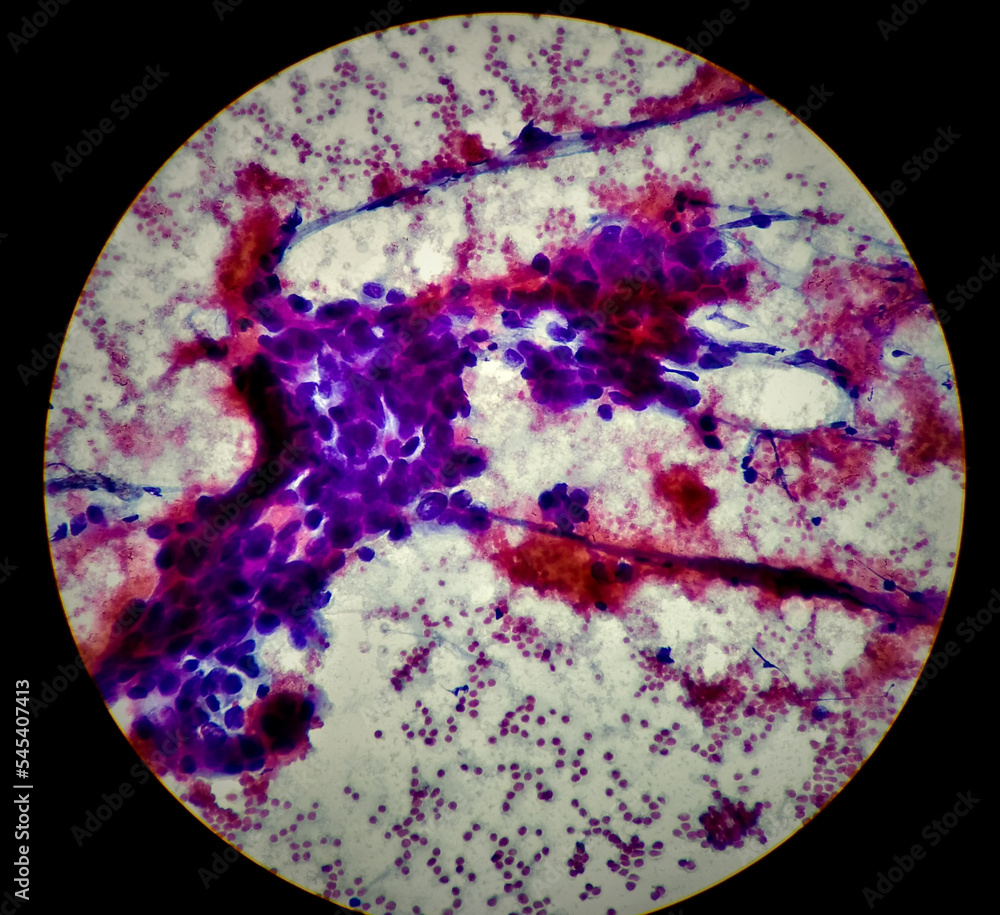 Intra abdominal mass(Cytology): Spindle cell sarcoma, positive ...