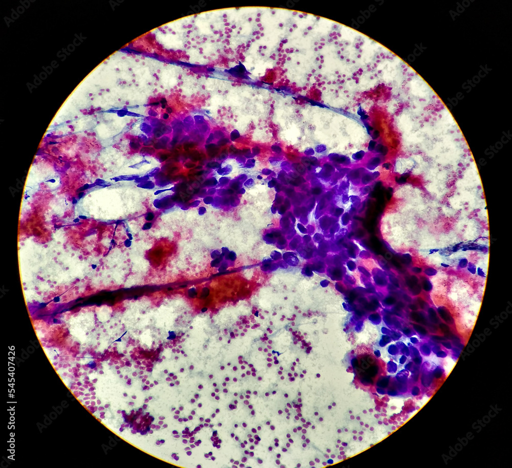 Intra abdominal mass(Cytology): Spindle cell sarcoma, positive ...