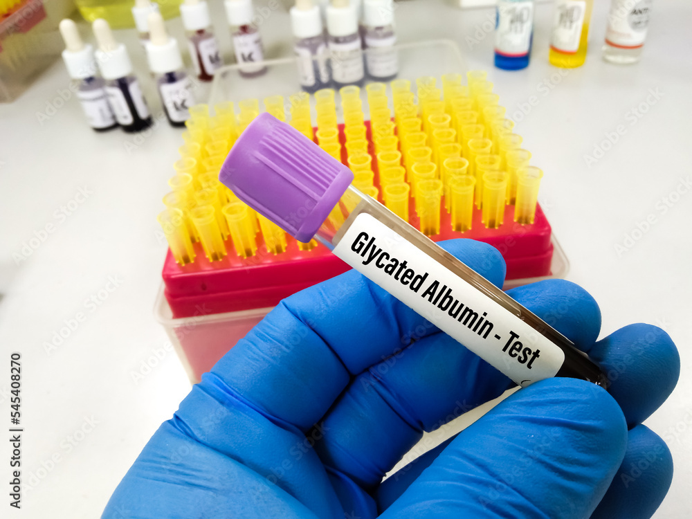 Blood sample for HbA1c - HPLC, Cystain C and Glycated Albumin test ...