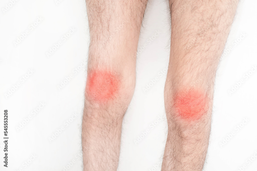 Piernas de un hombre delgado caucasico lastimadas de la rodilla ...