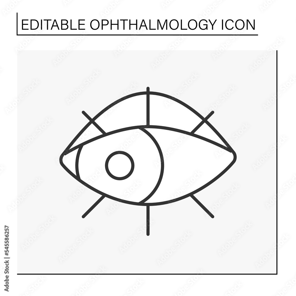 Strabismus line icon. Eye misalignment caused by extraocular muscle ...