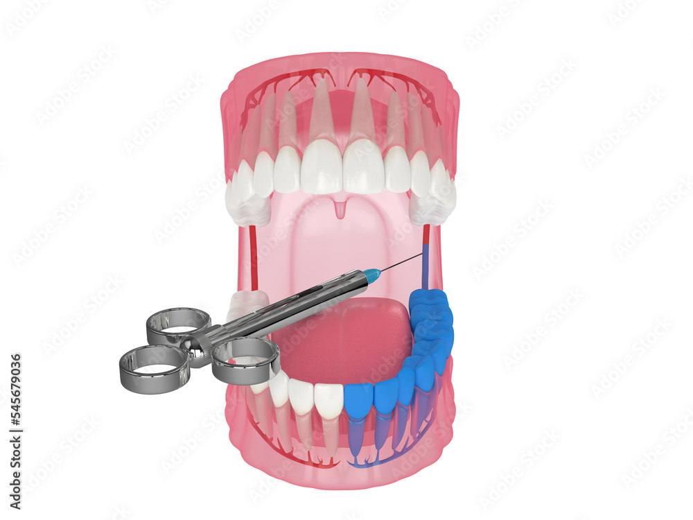 3d render of human jaw with inferior alveolar nerve block technique ...