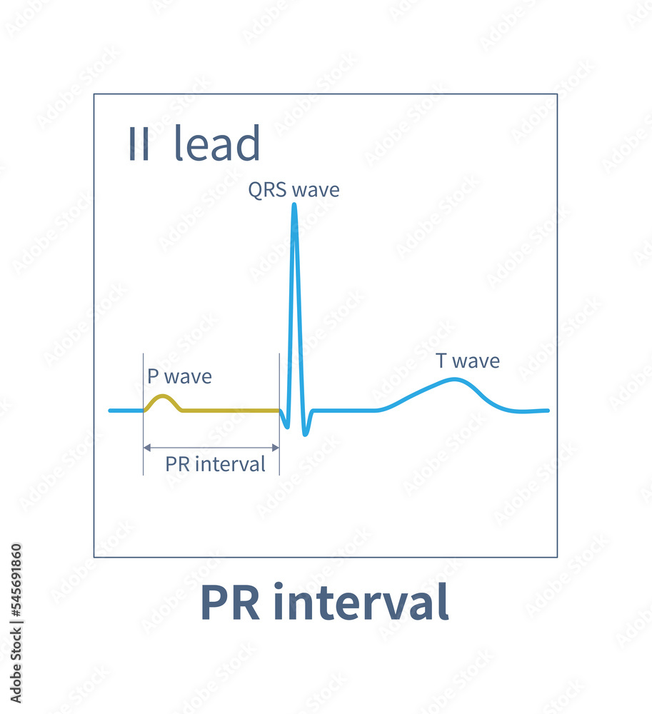 The PR interval of ECG refers to the time from the starting point of P ...