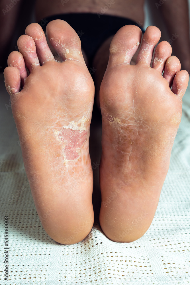 Cropped photo of half-naked man sitting on white sheet, showing peeling ...