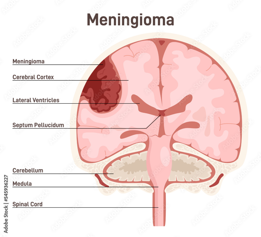 Meningioma. Brain tumor that forms from the meninges, the membranous ...