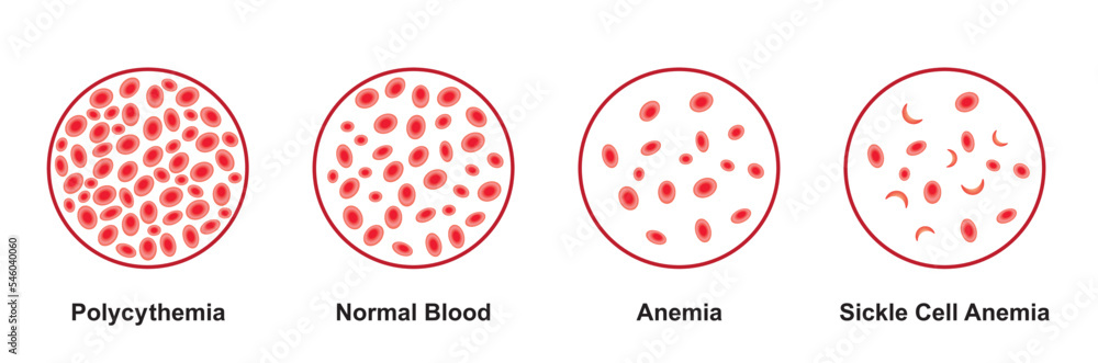Scientific Designing of Blood Anomalies. Comparison Between ...